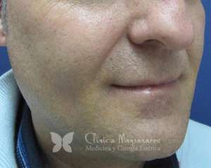 Bola Adiposa de Bichat - Centro de Medicina y Cirugía Estética Manzanares